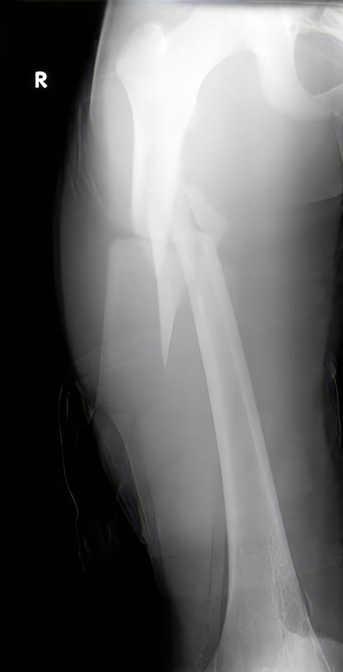 Rafi’s Recovery from Broken Bone to the Winner’s Circle - CHI Institute