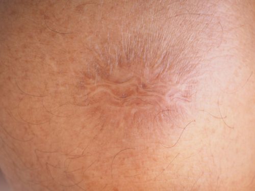 Hyaluronic Acid Dissolves Abdominal Scar Tissue - CHI Institute