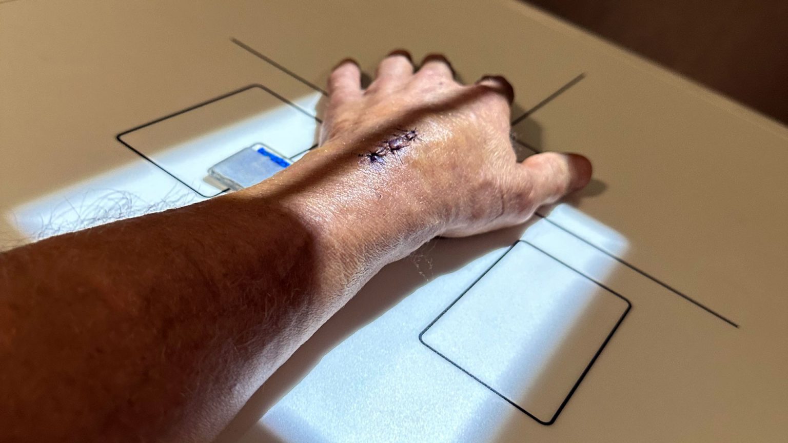 CHI Palm (Infratonic 11) - Pain Relief Where All Else Fails